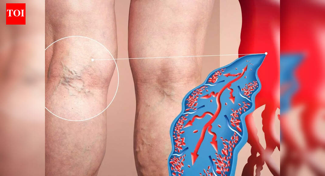 Blood Clot In Leg Symptoms | Deep Vein Thrombosis(DVT): Signs of blood ...