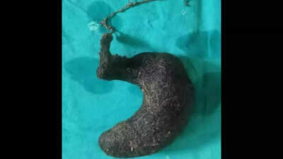 Civil Hospital: Hairball Extracted From Girl’s Stomach | Ahmedabad News ...