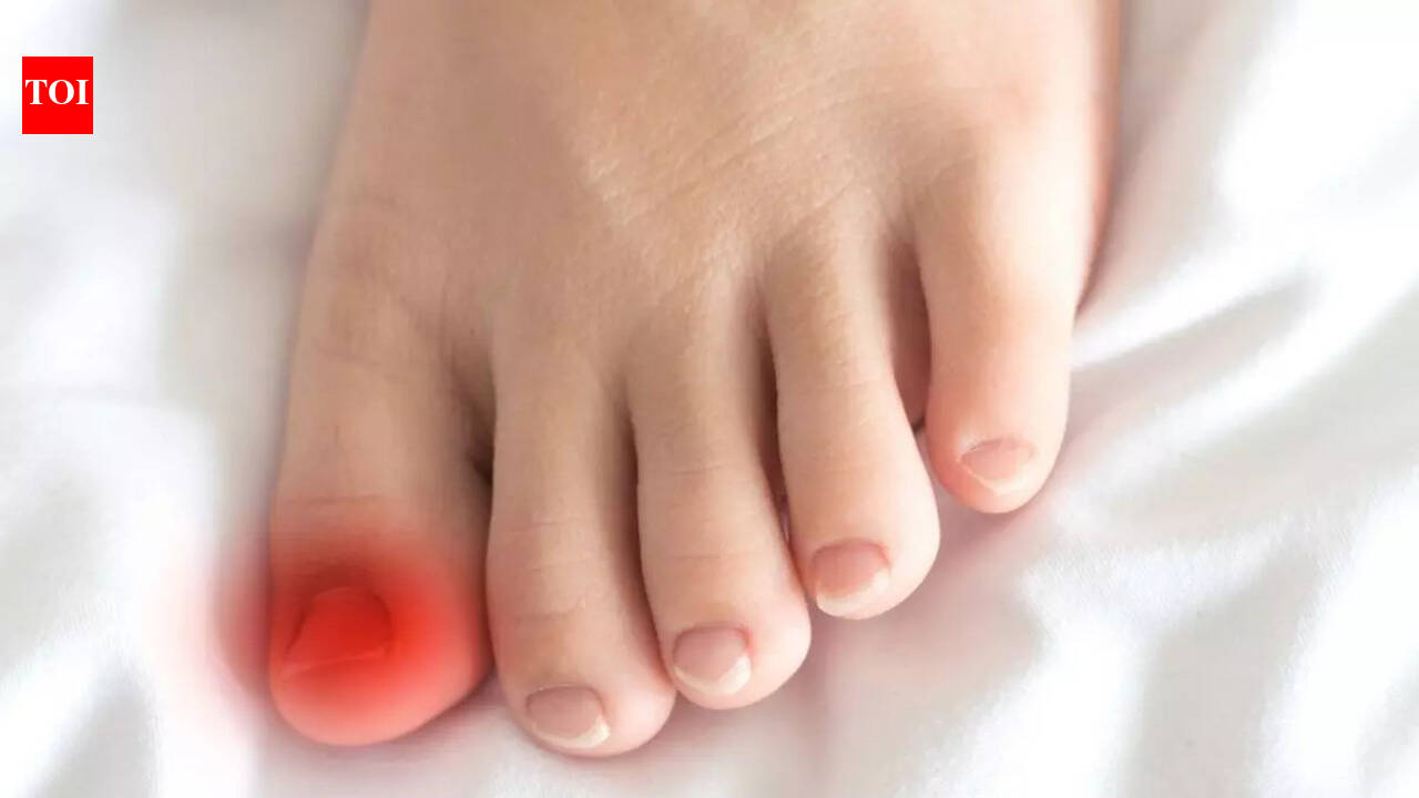Coronavirus symptom: COVID digits, a coronavirus-induced skin condition ...