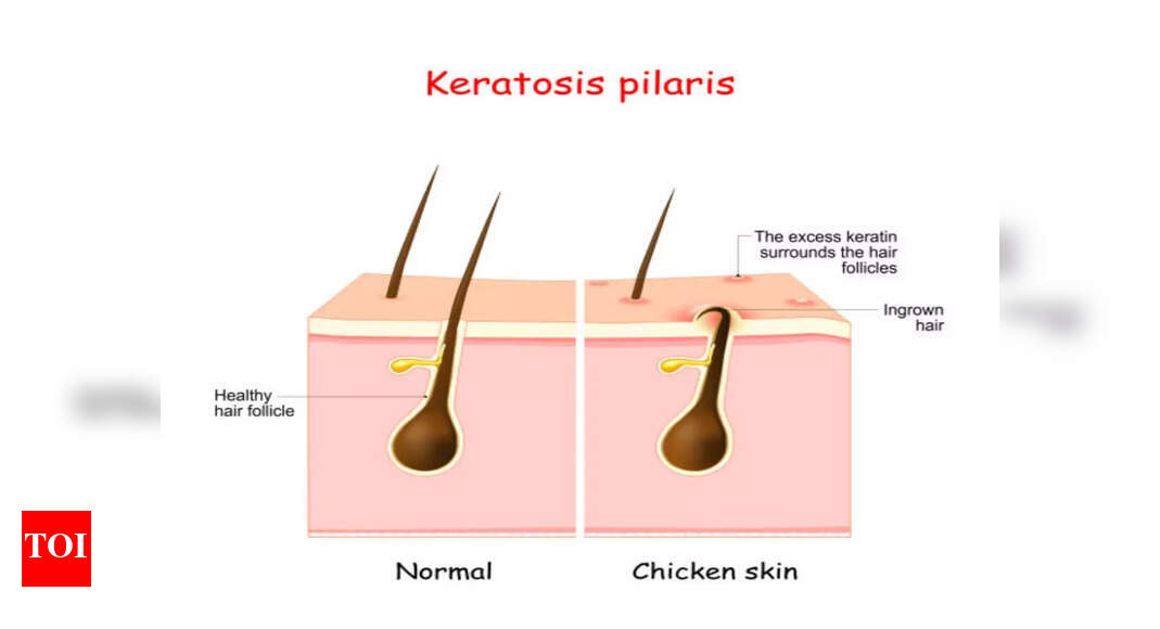 Keratosis Pilaris: This is how you can manage your ‘strawberry skin ...