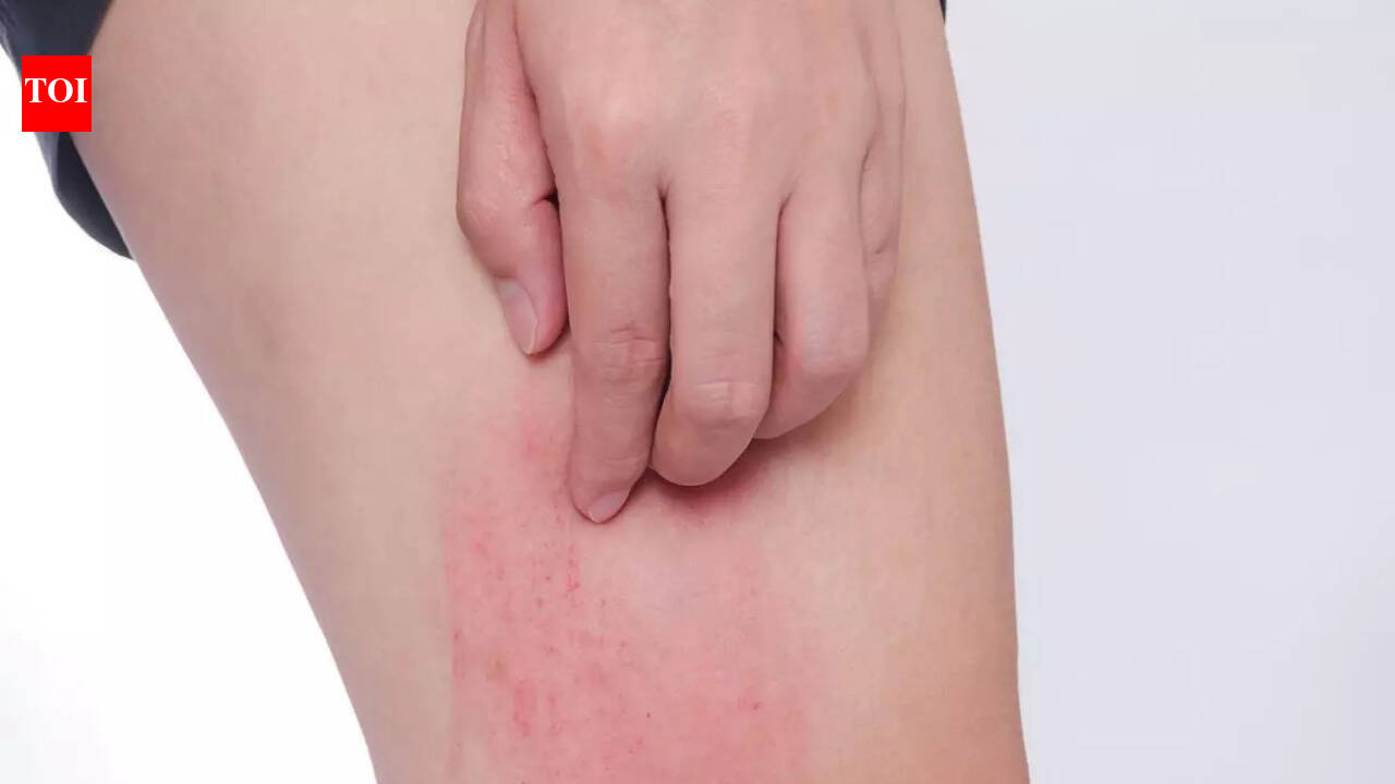 Skin chafing during monsoon: Tips to avoid chafing and how to recover ...
