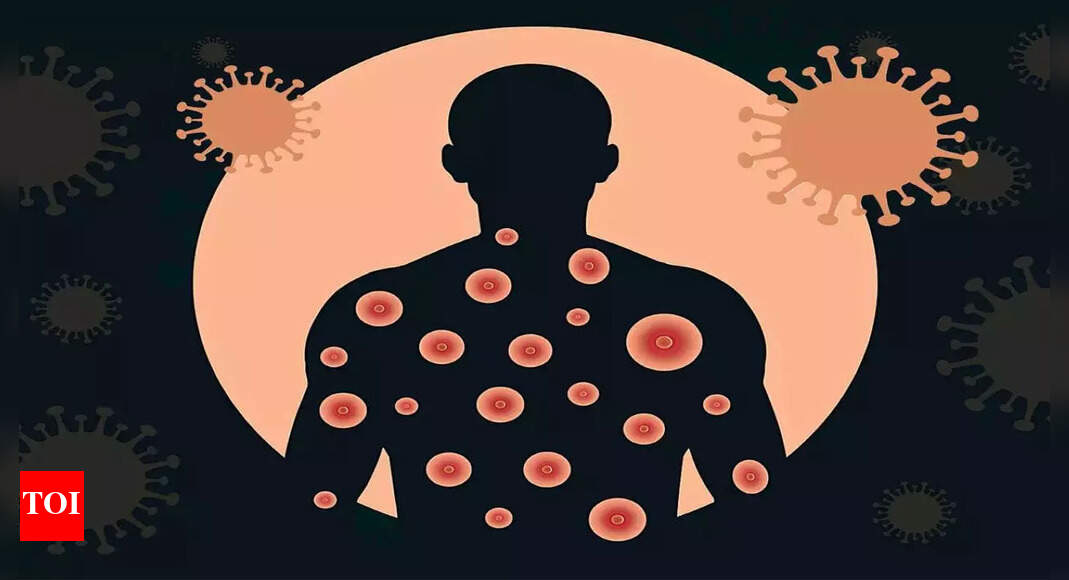 Monkeypox: Raj Monkeypox Scare: Balotra Woman Tests -ve, State On Alert ...