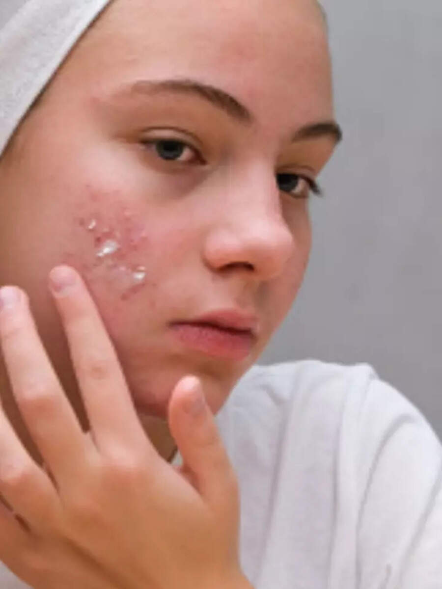 Skin care tips to avoid pimples before that hot date | Zoom TV
