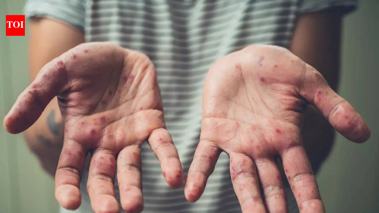 Monkeypox risk for kids: As more cases in kids are reported, here's ...