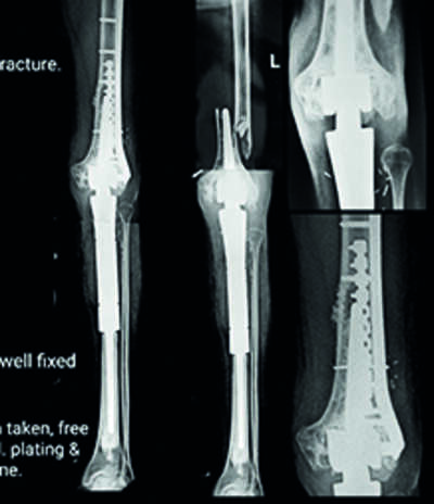 Docs: Docs Save Cancer Survivor’s Limb, Turn Him Into ‘ironman ...
