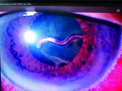 City Doctors Remove Live Roundworm From Monk’s Eye | Chennai News ...