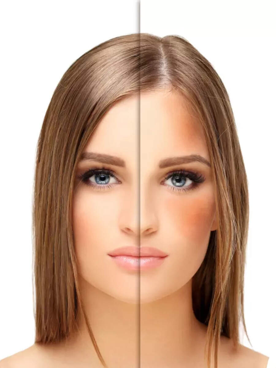 Skincare Tips: Ultimate hacks to fade facial scars naturally | Times of ...