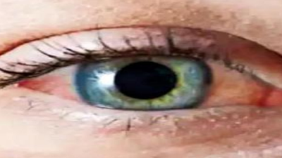 Cases of conjunctivitis soar in Chennai | Chennai News - Times of India