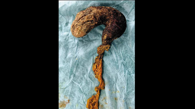 Hairball Removed From 12-year-old Girl’s Stomach | Vadodara News ...