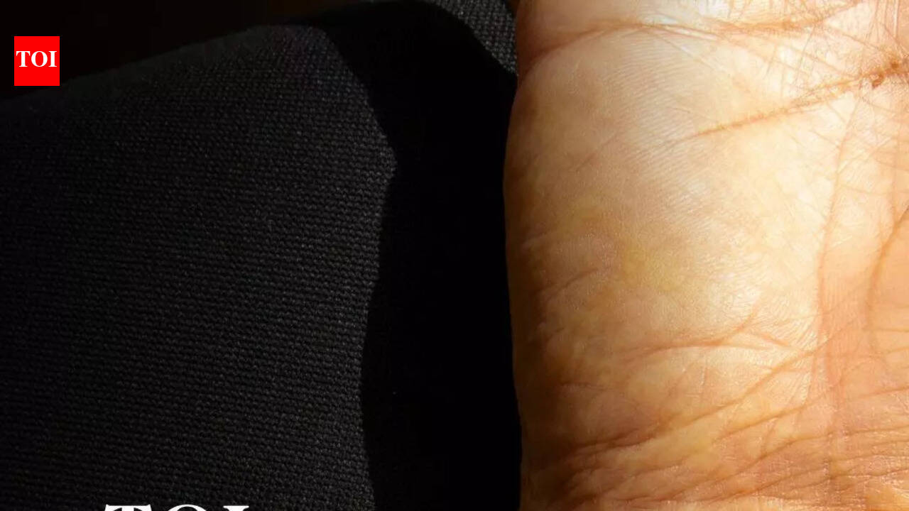 Lakhs of burn injuries every year, but India only has 17 skin banks