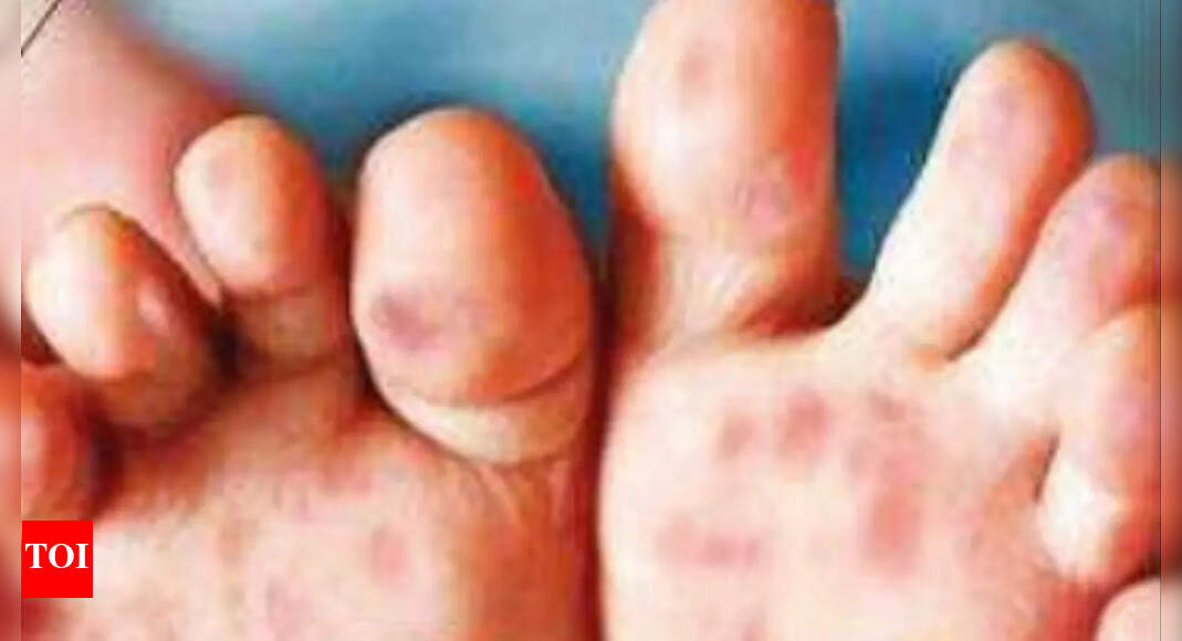 Virus Behind Hfmd Outbreak In Us Causing Illness In City Kids ...