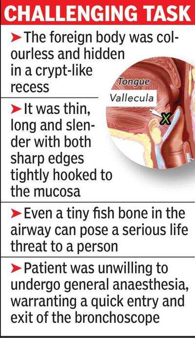 Anaesthesia: Fish bone stuck in throat removed without general ...