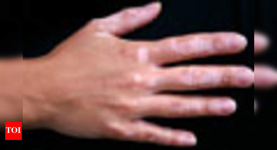 Get rid of those white patches! - The Times of India