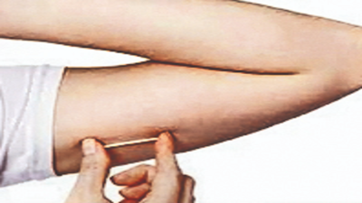 Implanon Nxt: Fpai: New Contraceptive For Women Is More Effective ...