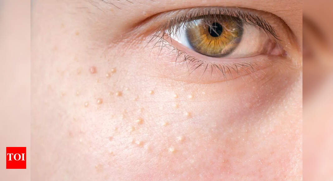 Revealed: What are those white bumps on your face? - Times of India