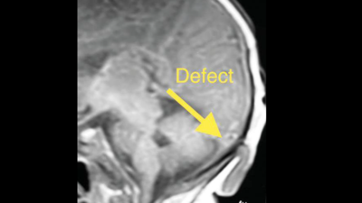 Kolhapur: Baby Boy Born With Rare Skull Defect Treated | Kolhapur News ...