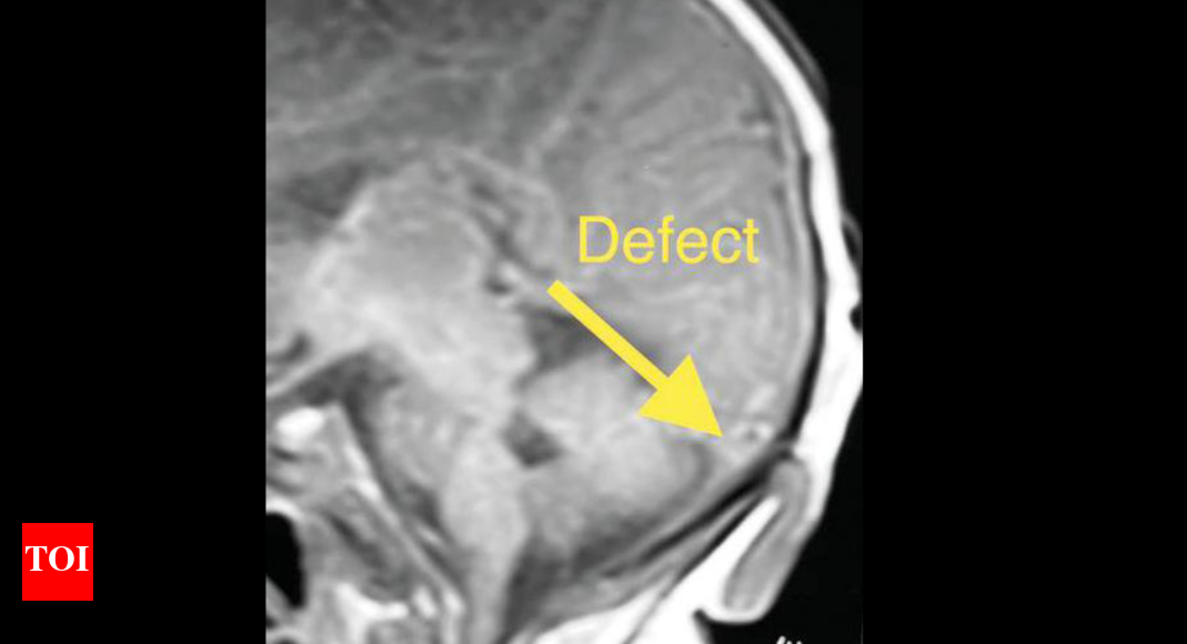 Kolhapur: Baby Boy Born With Rare Skull Defect Treated | Kolhapur News ...
