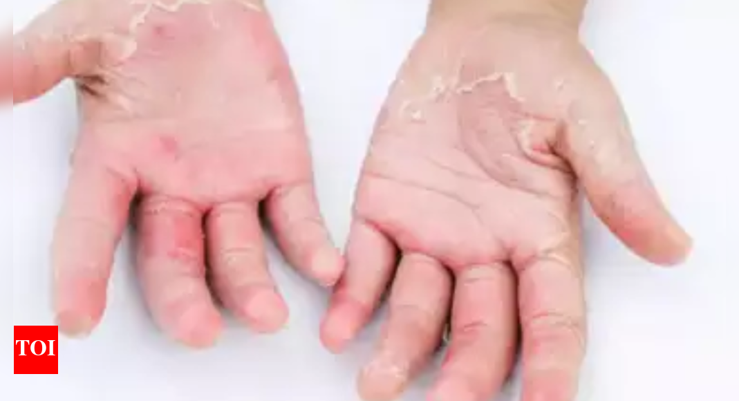 Why ringworm may be turning drug-resistant | Delhi News - Times of India