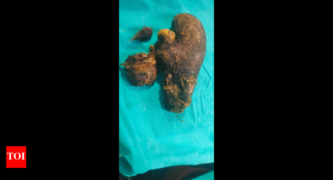 Up Girl 14 Operated For Rapunzel Syndrome 2 Kg Of Hair Removed