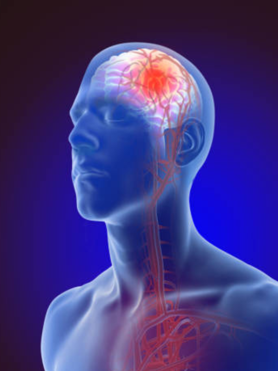 Top 4 Stroke Symptoms Seen In 75 Of The Cases Times Of India