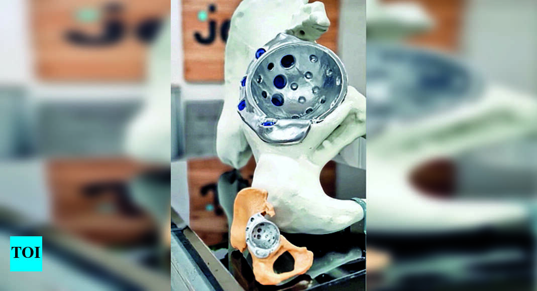 Worlds: World’s Largest 3d Printed Hip Model To Be Unveiled | Vadodara ...